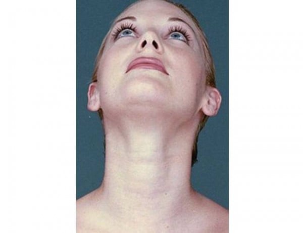 Facial Exercises To Avoid or Get Rid Of Double Chin