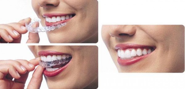 Top 7 Things You should Know about Invisalign