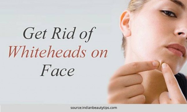 How to Get Rid of Whiteheads: Home Remedies