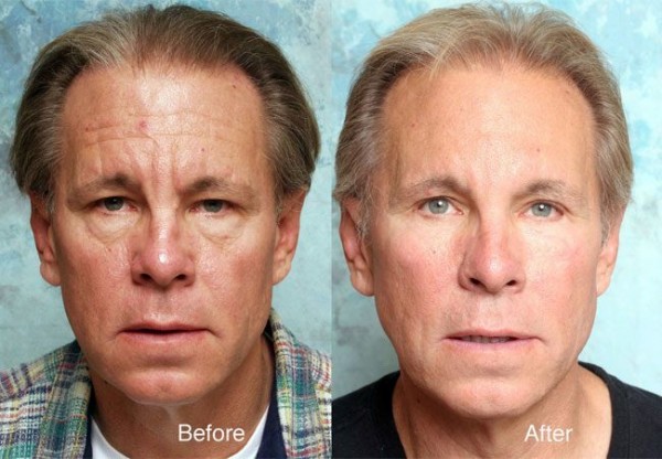 Chemical Peels - Everything You Wanted to Know About it