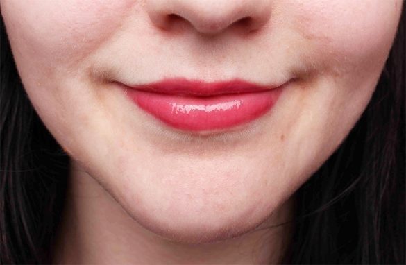 Know All About Lip Reduction Without Surgery