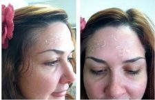 Post Peel Treatment Skin Serums Your Dermatologist Would Recommend