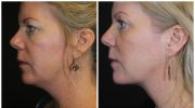 How to Get Rid of Neck Fat to Improve the Way you Look