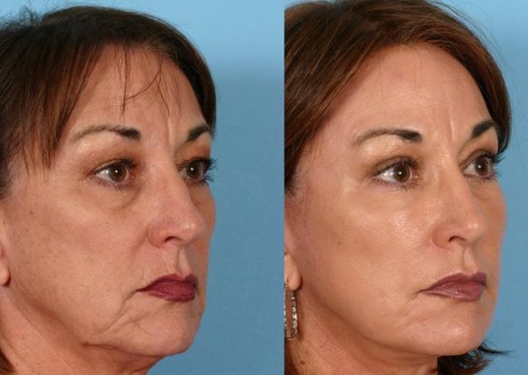 A Sneak Peak Into The Wonders Of Dermabrasion Revealed!