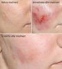 A Sneak Peak Into The Wonders Of Dermabrasion Revealed!