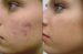 A Sneak Peak Into The Wonders Of Dermabrasion Revealed!