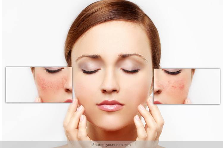 Heres How To Get Rid Of Face Redness Easily