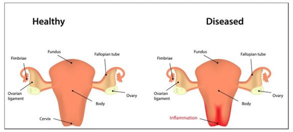 Itching in Private Parts (vaginal Itching) : Causes, Symptoms and Treatment
