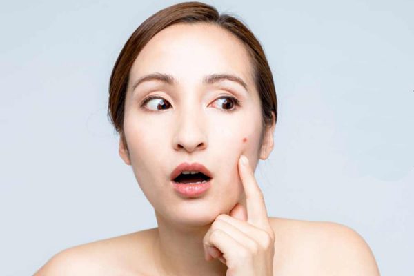 32 Amazing Home Remedies To Get Rid Of Boils