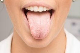 17 Natural Treatment Methods To Get Rid Of White Tongue At Home