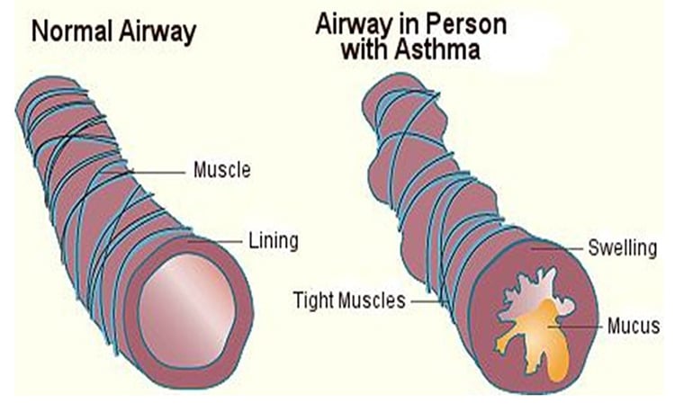 How To Cure Asthma Naturally Permanently How To Cure Asthma Naturally Permanently