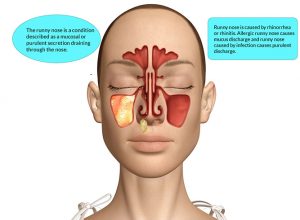 How To Stop Runny Nose